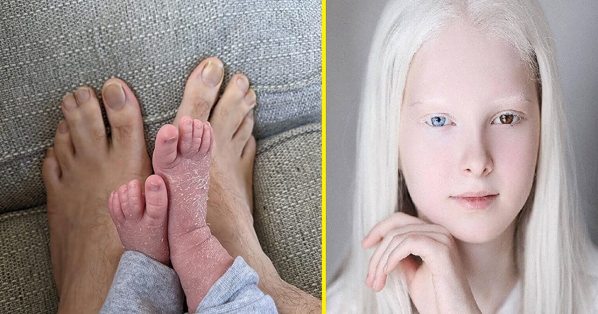 9 People Whose Genetics Make Them Super Unique! - Genmice