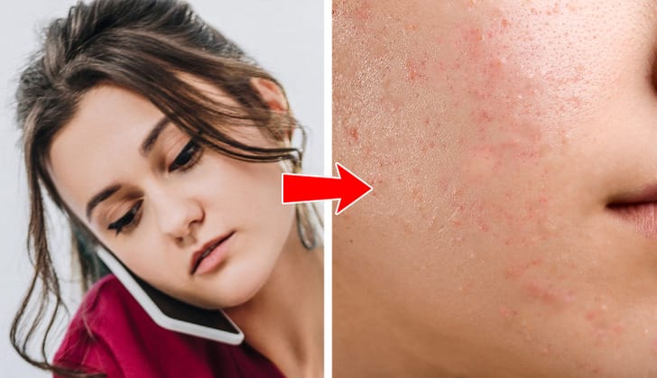 What the Acne on 7 Body Parts Is Trying to Tell You About Your Health ...
