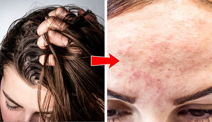 What the Acne on 7 Body Parts Is Trying to Tell You About Your Health ...